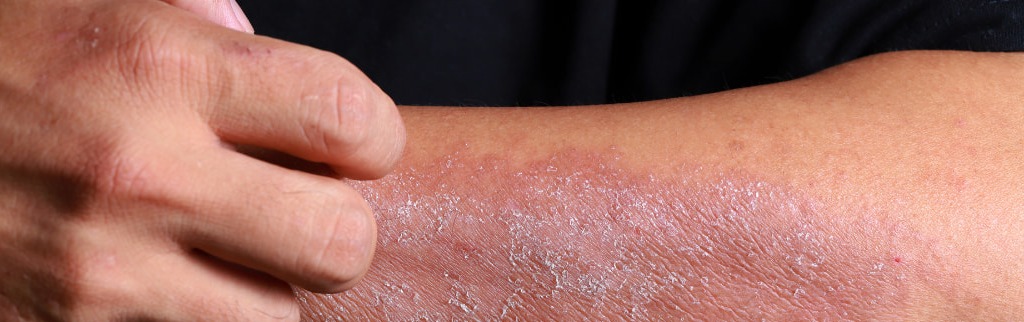 IBD and skin problems - Carenity