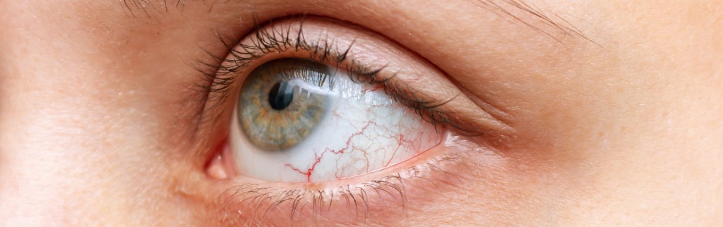 IBD and eye disorders: understanding the link. - Carenity